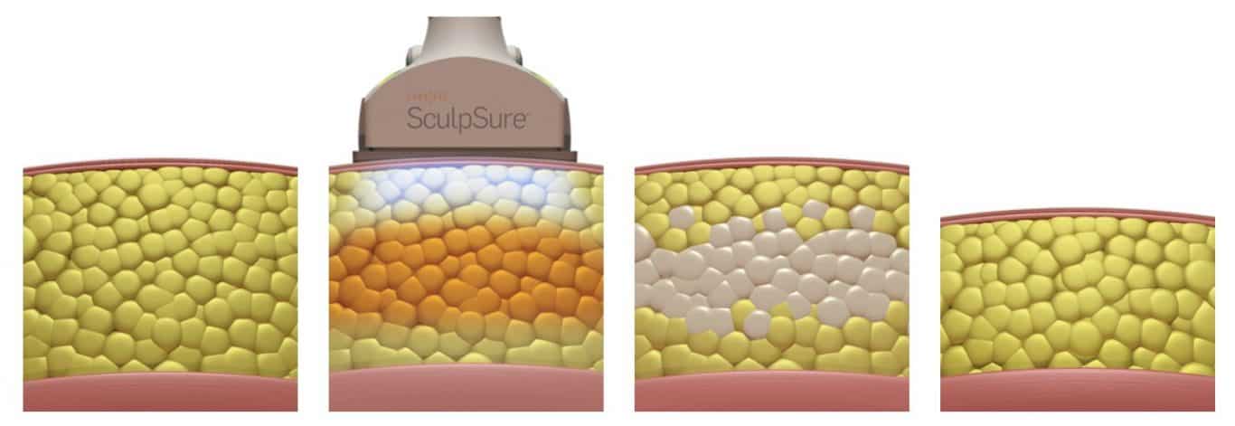 SculpSure 25分钟快速永久性溶脂吗？ | คลินิคคลินิก