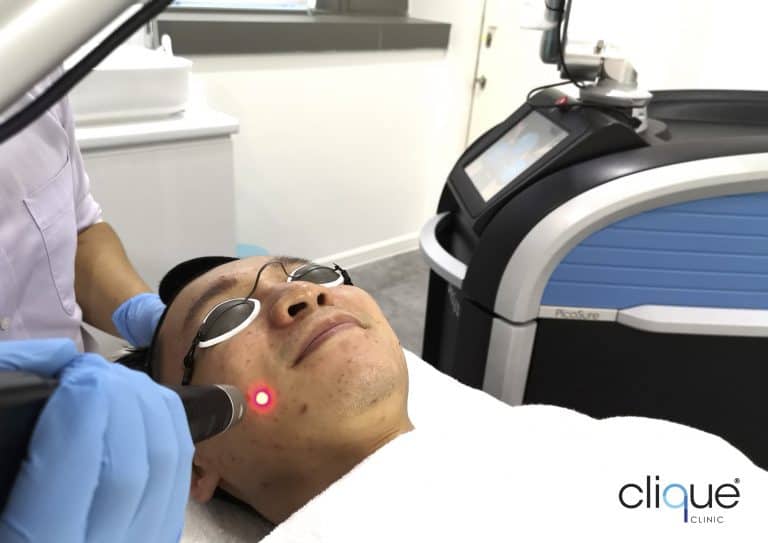 Best Laser For PIH (Post-Inflammatory Hyperpigmentation): PicoSure ...