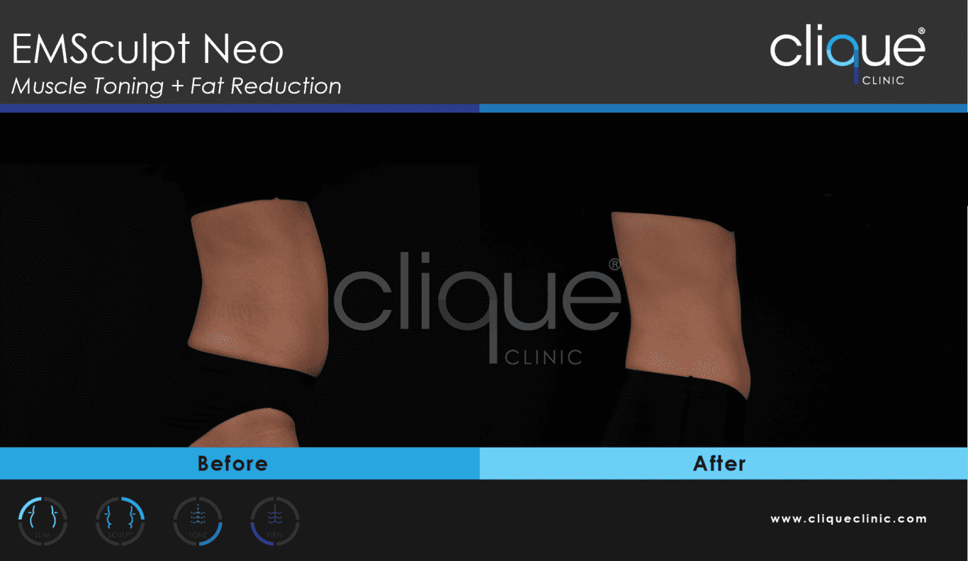 Fotos de antes y después de EMSculpt Neo | Clínica Clique