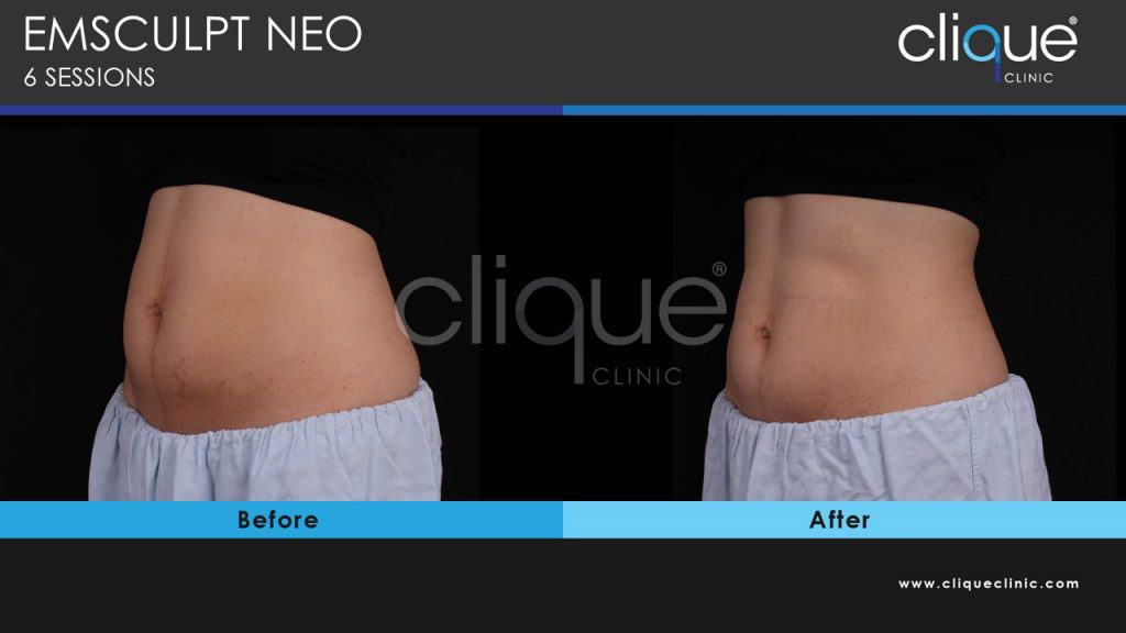 Fotos de antes y después de EMSculpt Neo | Clínica Clique