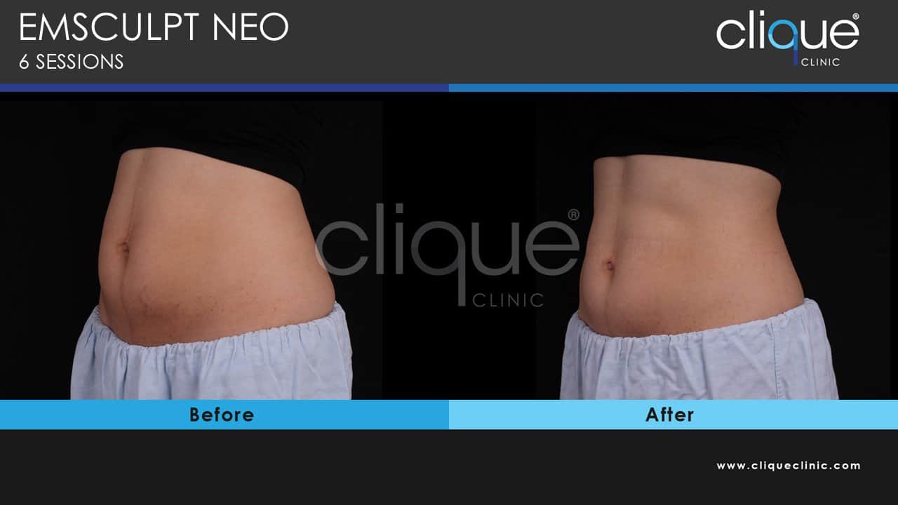 EMSculpt Neo Review - Year 2022 | Clique Clinic