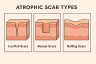 Understanding Atrophic Scars: Causes, Prevention, & Treatments | Clique ...