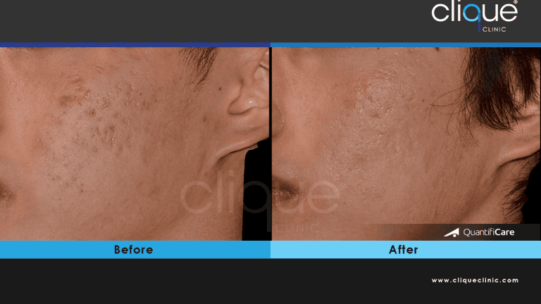 Understanding Atrophic Scars: Causes, Prevention, & Treatments | Clique ...