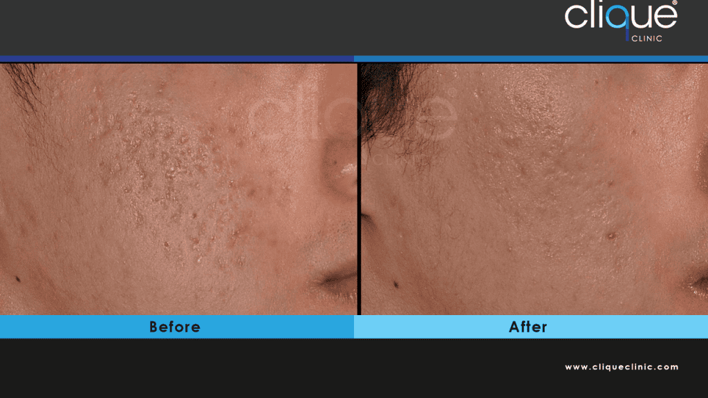 Understanding Atrophic Scars: Causes, Prevention, & Treatments | Clique ...