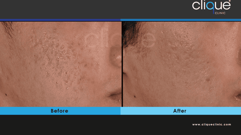 Understanding Atrophic Scars: Causes, Prevention, & Treatments | Clique ...