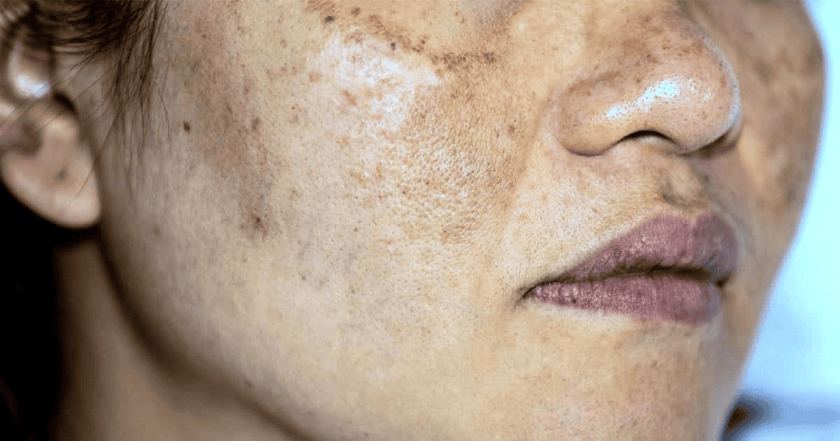 what is melasma hyperpigmentation